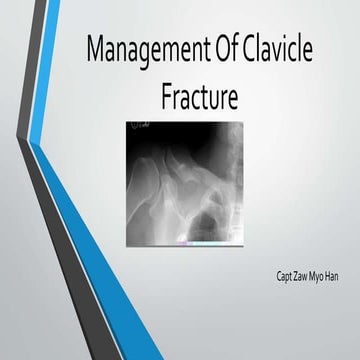 managements of the clavicle fracture.pptx