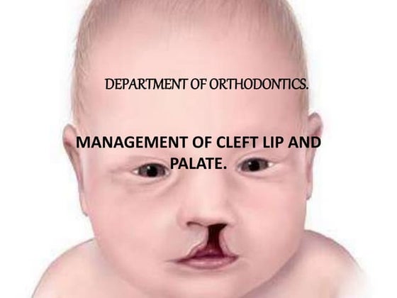 Cleft palate and vpi | PPT