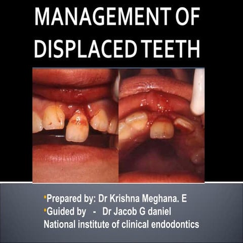 Management of displaced tooth | PPT