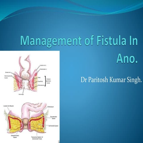 Management of fistula of ano. | PPTX
