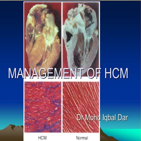 Management of HCM | PPTX