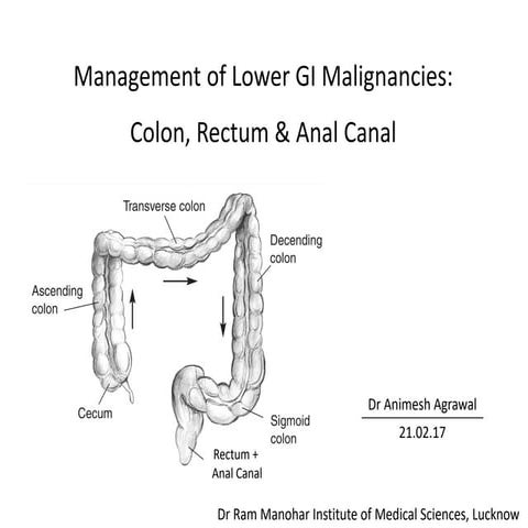 Management of lower Gastrointestinal malignancies | PDF