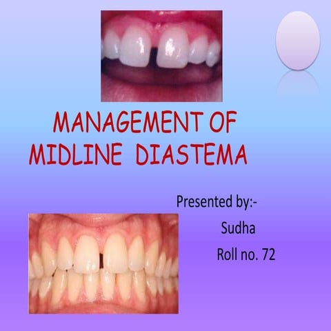 Management of midline diastema | PPTX
