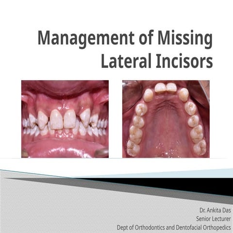 Management of Missing Lateral Incisors.pptx