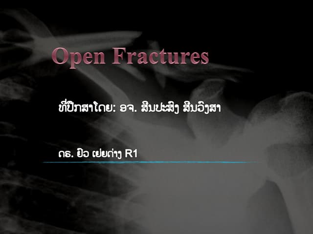 Open Fracture | PPTX