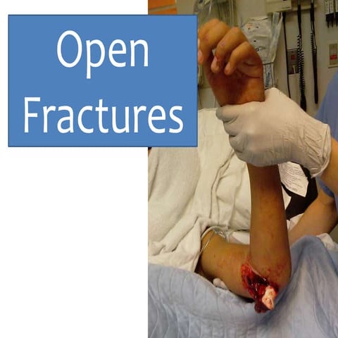 management_of_open_fractures.pptx