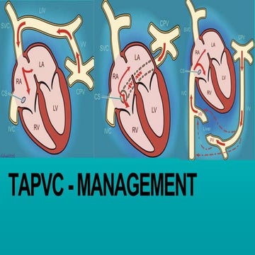 Management of tapvc | PPTX