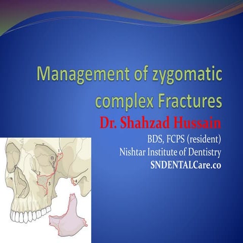 Management of zygomatic complex fractures | PPTX