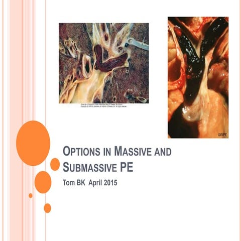 Management options in massive and submassive pulmonary embolus | PPTX