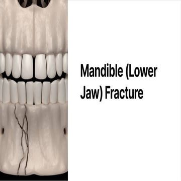 Mandible-Lower-Jaw-Fracture (1).pdf | Death, Injury, or Military ...