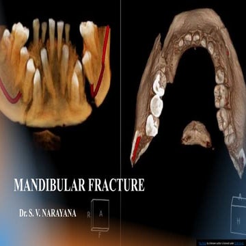 Mandibular Fracture