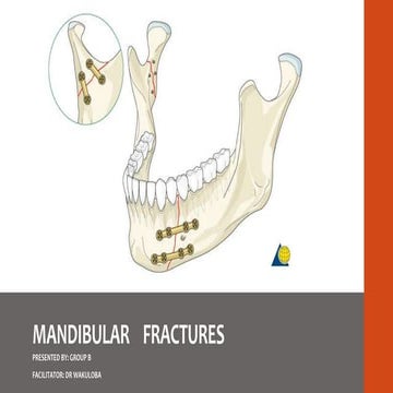 Symphysis & Angle MANDIBULAR FRACTURES | PDF