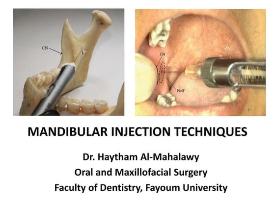 Mandibular Anesthesia : Inferior alveolar nerve block | PPT