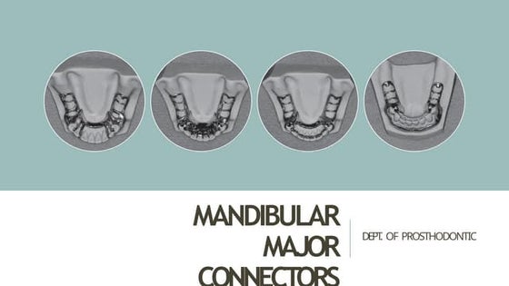 RPD Major Connectors | PPSX | Dental Health | Diseases and Conditions