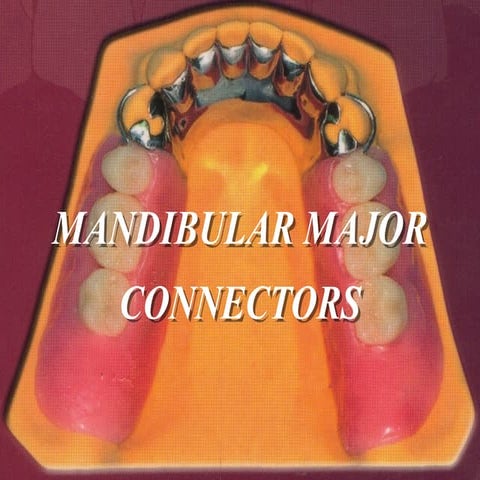 Mandibular Major Connectors | PPTX