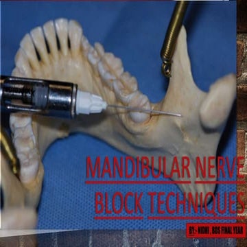 Nerve Block Mandibular Nerve Block Technique Nerve Block: Mandibular