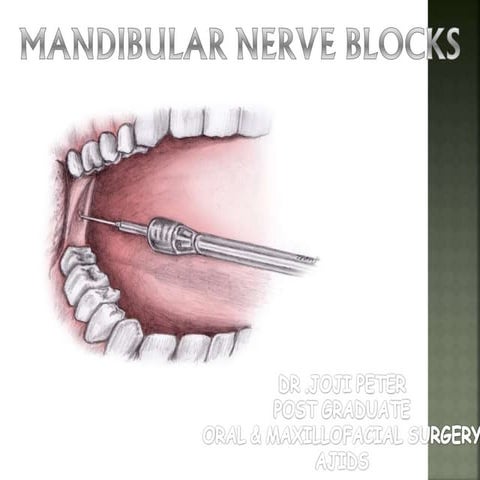 Nerve Block Mandibular Nerve Block Technique Nerve Block: Mandibular