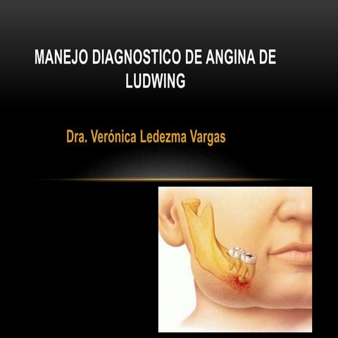 Manejo diagnostico de angina de ludwing | PPTX