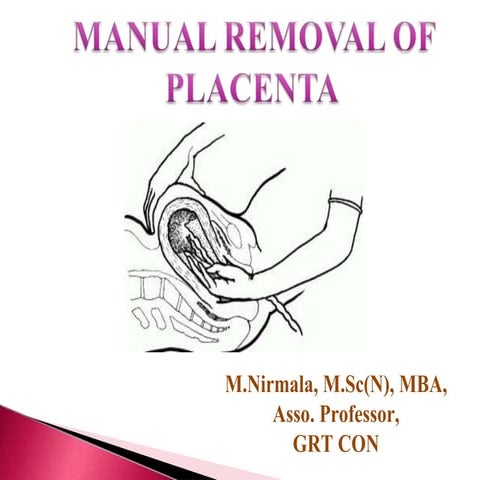 Manual removal of placenta.pptx