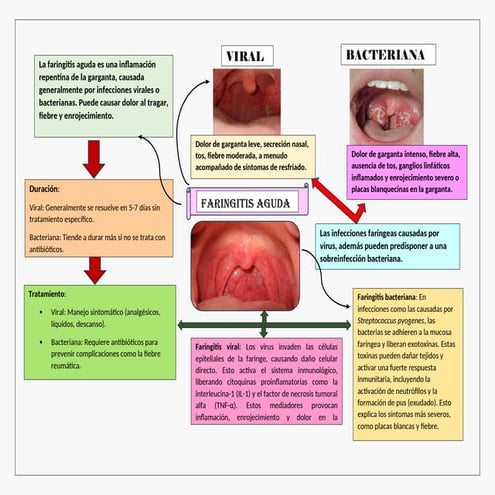 Faringitis-Viral. causas , cuidados y como prevenirlo | PPTX