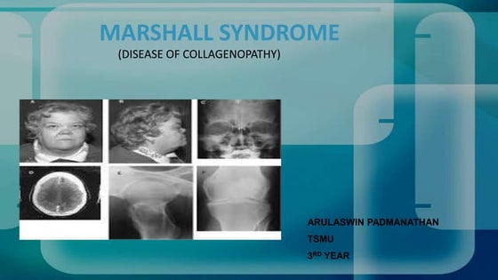 A case of Alport syndrome presented with bilateral anterior lenticonus ...