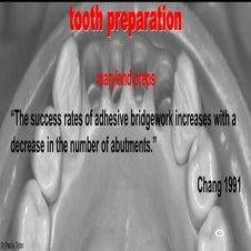Tooth Preparation - Maryland preps | PDF