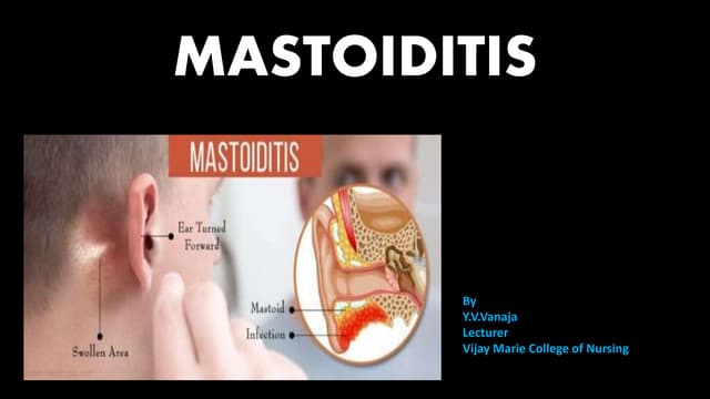 Mastoiditis | PPTX