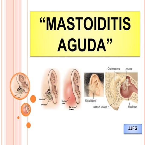 Mastoiditis | PPTX