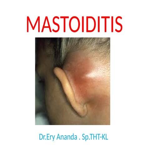 MASTOIDITIS UNAYA 2017.pptxxxxxxxxxxxxxx | PPT