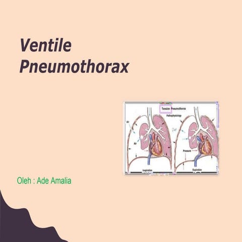 Masukan Ventil Pneumotoraks by Amalia.pptx