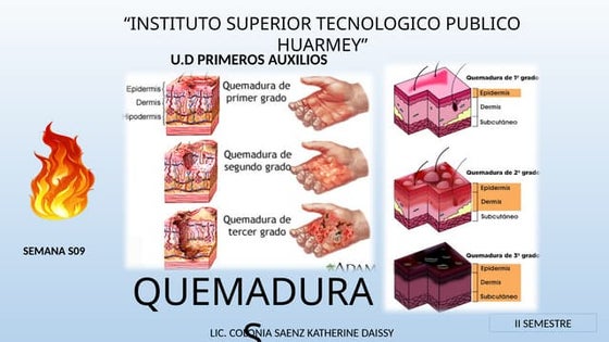 Primeros Auxilios-Quemaduras | PPT