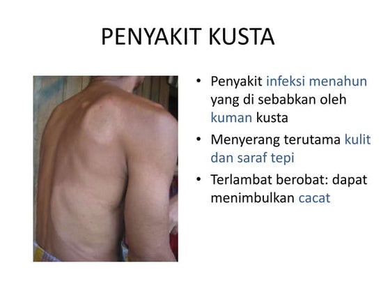 materi penyuluhan kusta.pptx