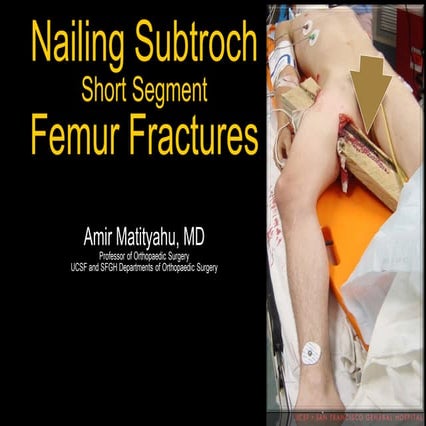 Nailing subtrochanteric short femur fractures | PDF