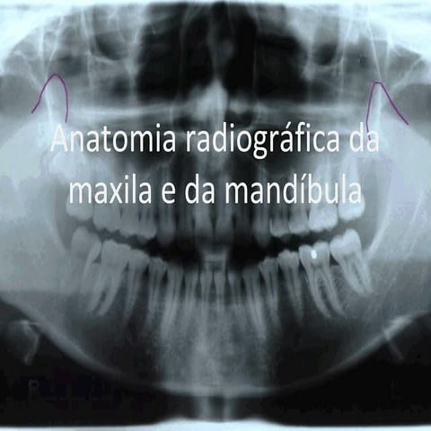 Arco Tipo I e Tipo II de Baume - Resumo Concurso Público de Odontologia.pdf