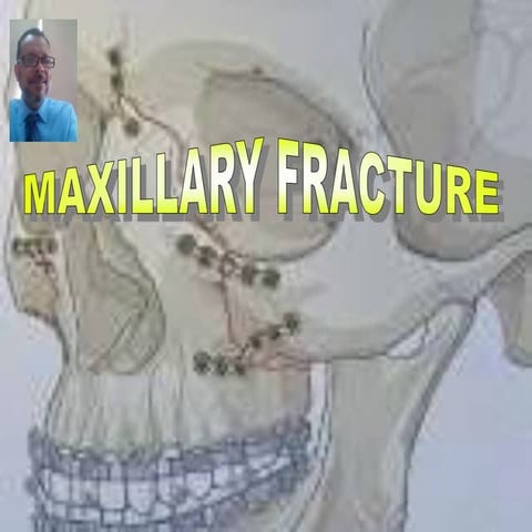 Mid face fracture-Maxillary fracture | PPT