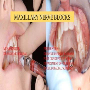 maxillary nerve blocks | PPT