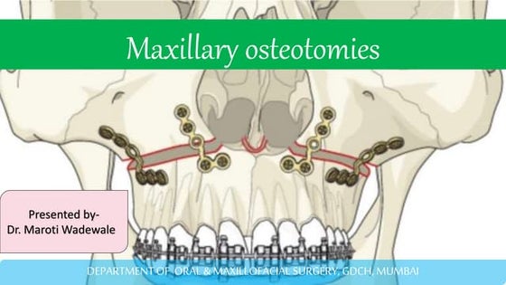 ANTERIOR SEGMENTAL MAXILLARY OSTEOTOMY.pptx