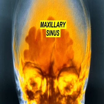 Maxillary sinus | PPTX