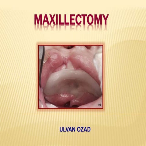 Maxillectomy | PPT
