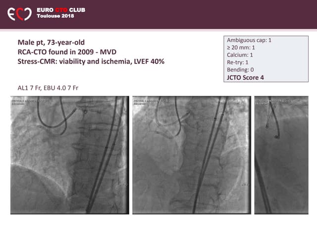 J Cto Score ≥3 Ppt