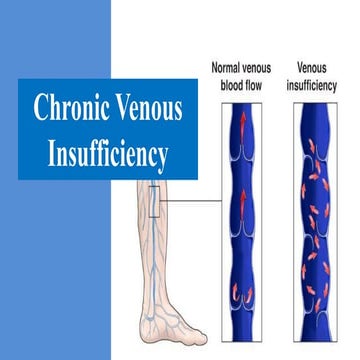 MD61 Group2 - Chronic Venous Insufficiency (Presentation).pdf