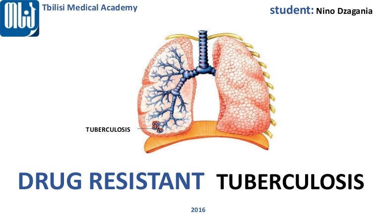 Drug resistant Tuberculosis