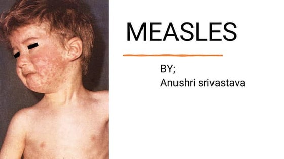 Measles | PPTX | Infectious Diseases | Diseases and Conditions