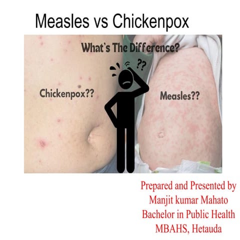 Measles vs chickenpox with definition , causes, symptoms, stages ...