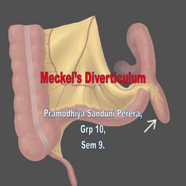 meckels diverticulum.pptx