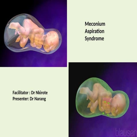 Meconium-Aspiration-Syndrome presentation.pptx