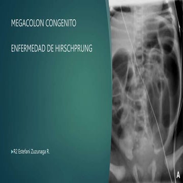 megacolon congenito terminado.pptx