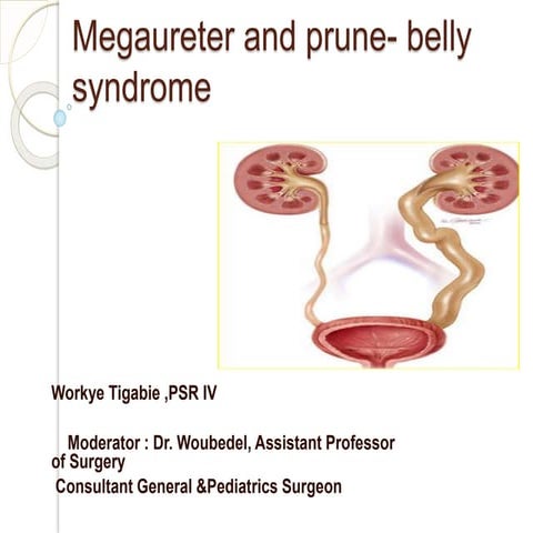megaureter.pptx