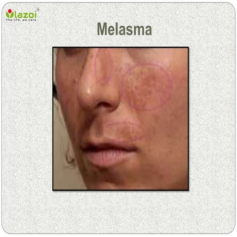 Melasma | PPTX