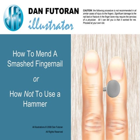 Mending A Smashed Finger | PPT | First Aid | Injuries